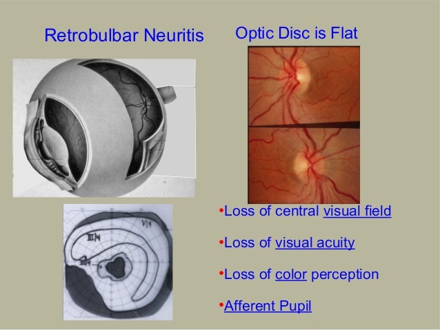 Optic neuritis