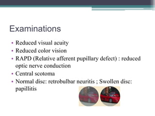 Optic neuritis | PPTX
