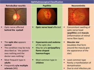 Optic neuritis | PPTX