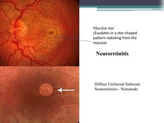 Optic neuritis | PPTX