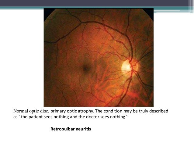 Optic neuritis