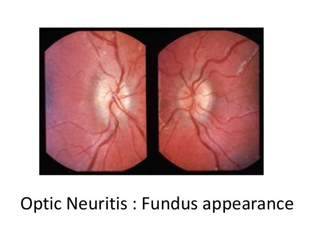Optic neuritis