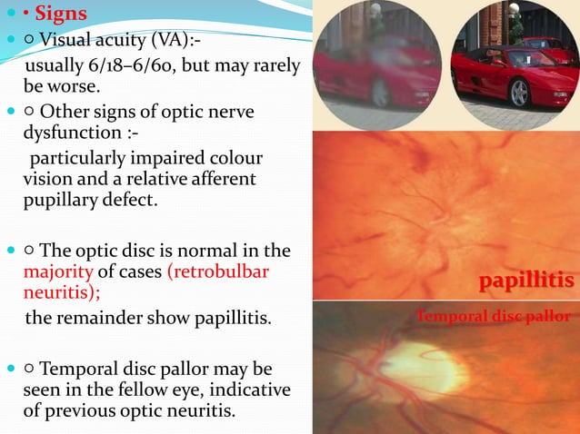 Optic neuritis | PPT