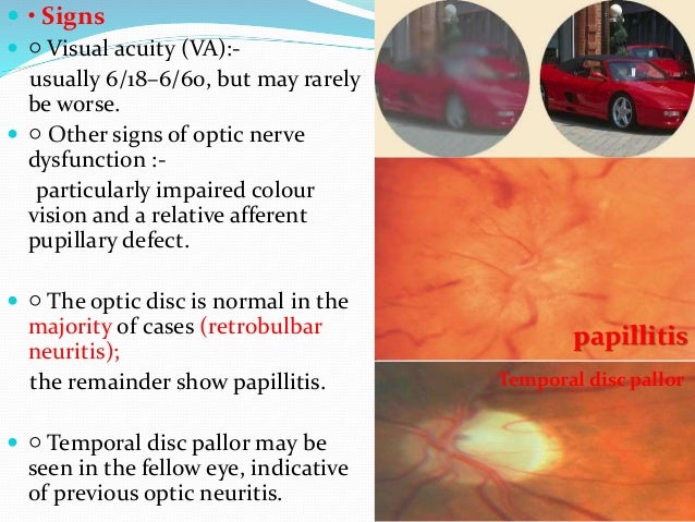 Optic neuritis