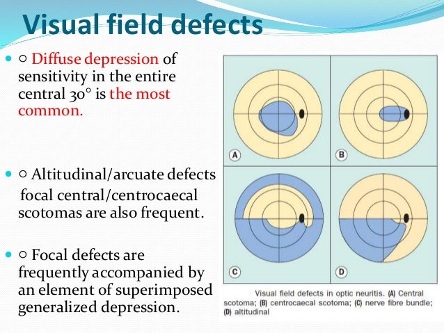 Optic neuritis