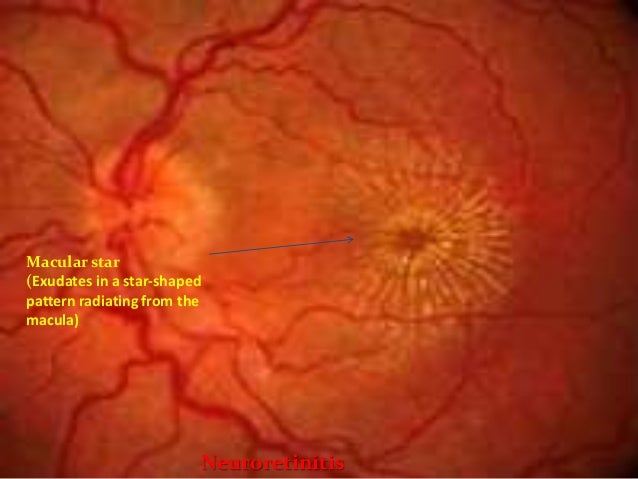 Optic neuritis