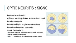 Optic neuritis | PPTX