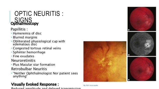 Optic neuritis