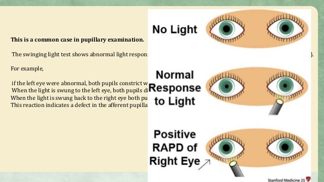 Optic neuritis