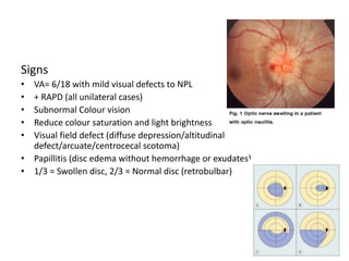 Optic neuritis & Multiple Sclerosis (2018) | PDF