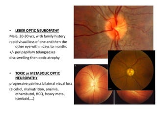 Optic Neuritis Multiple Sclerosis
