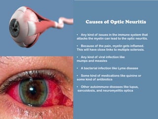 Optic neuritis | PDF