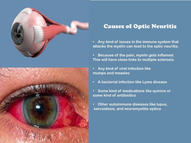 Optic neuritis | PPT