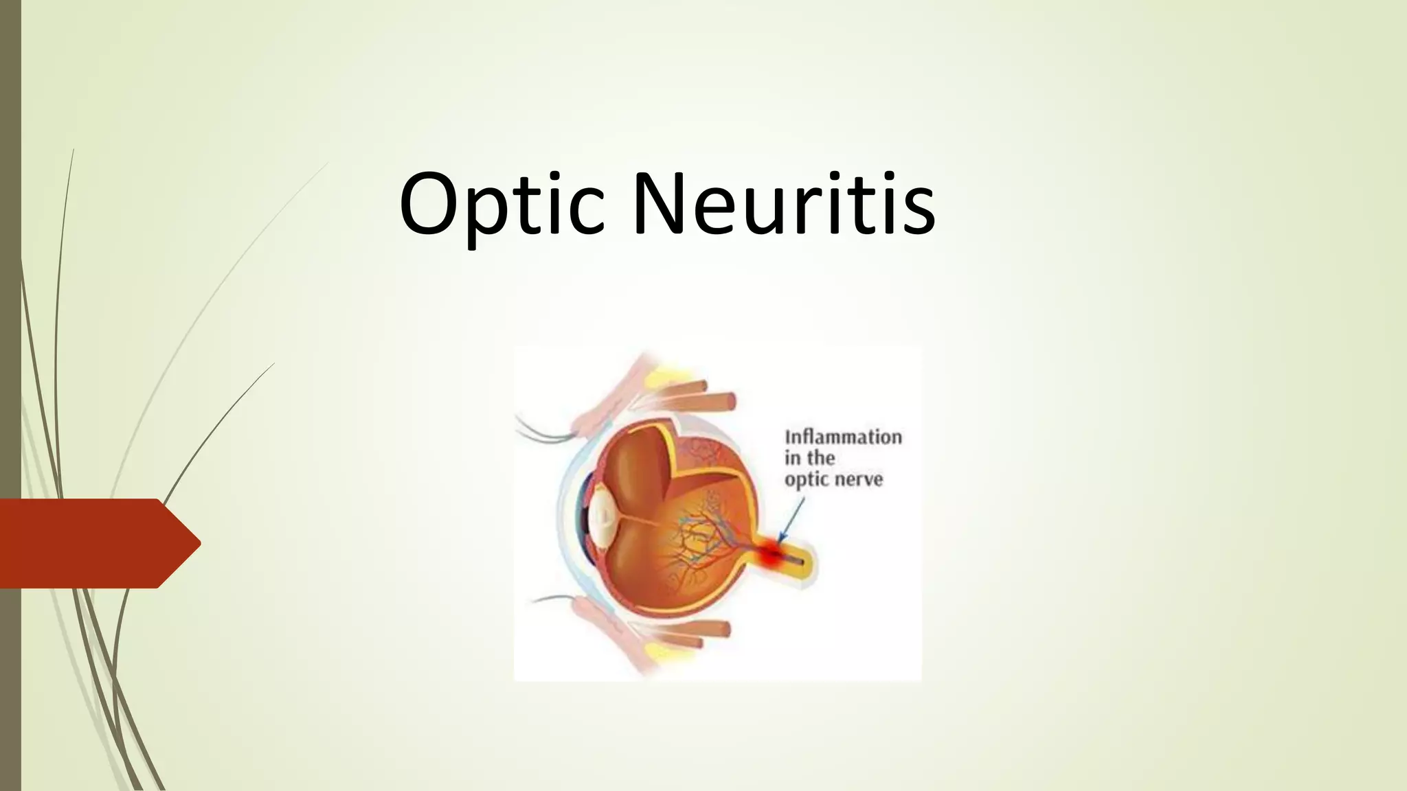 Optic Neuritis Pptx