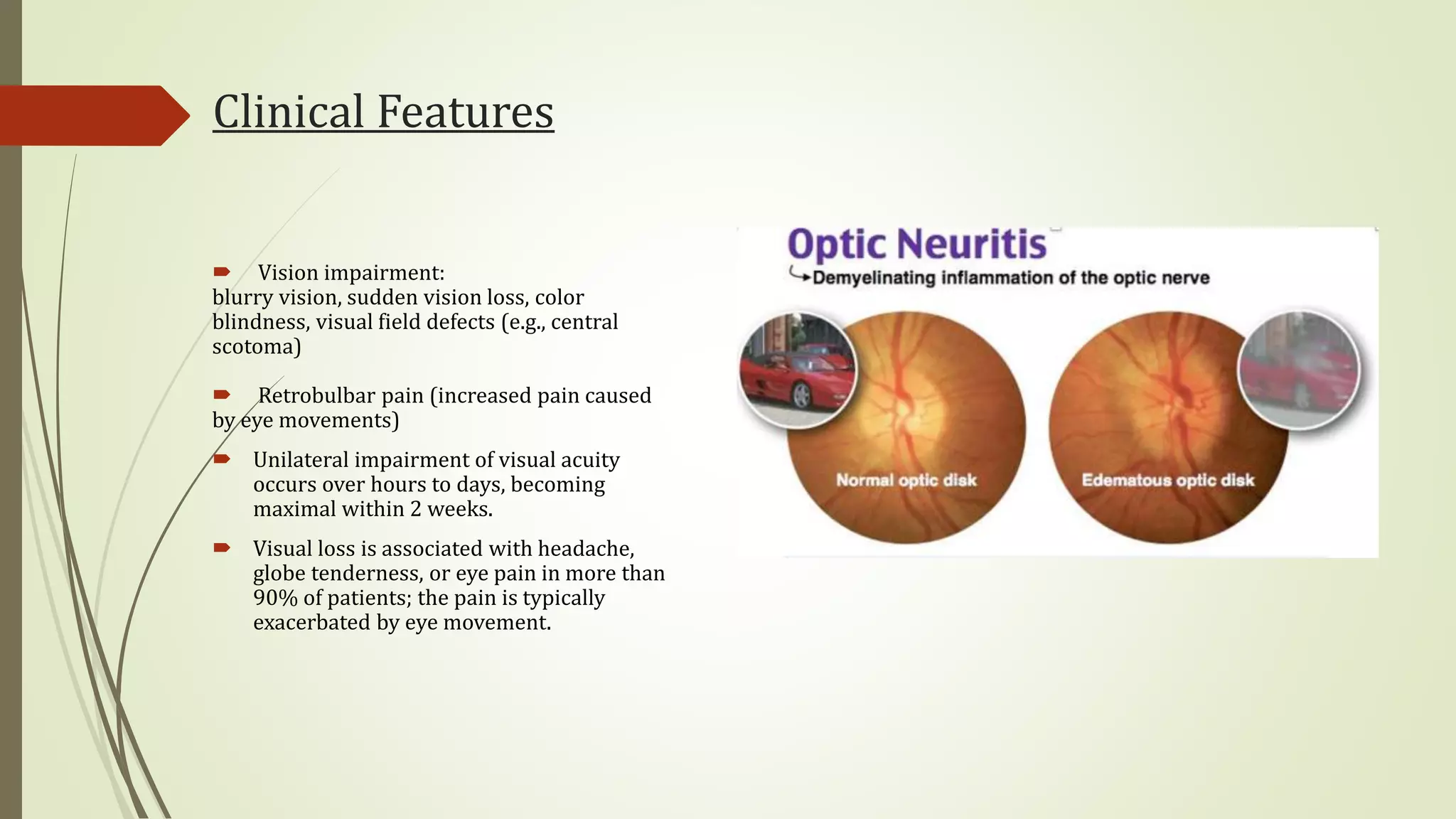Optic Neuritis .pptx