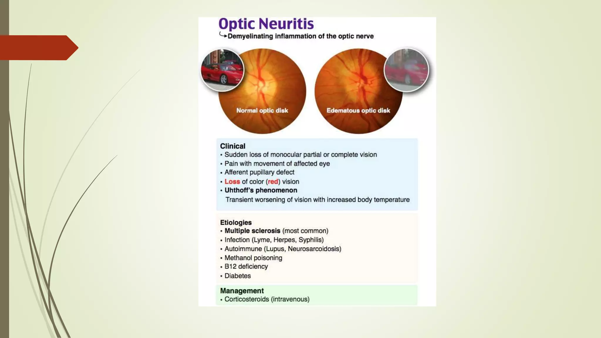 Optic Neuritis .pptx