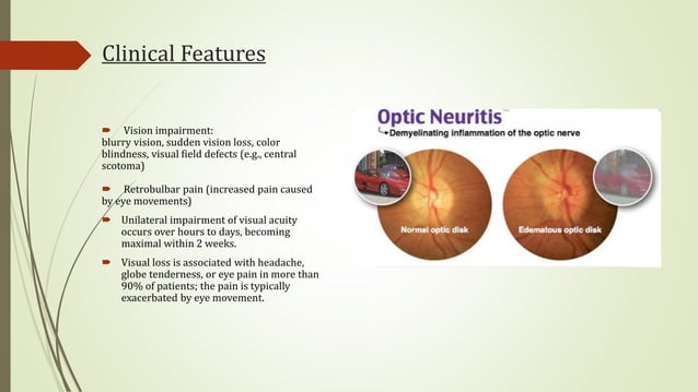 Optic Neuritis Pptx