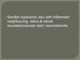 Optic Neuritis.pptx