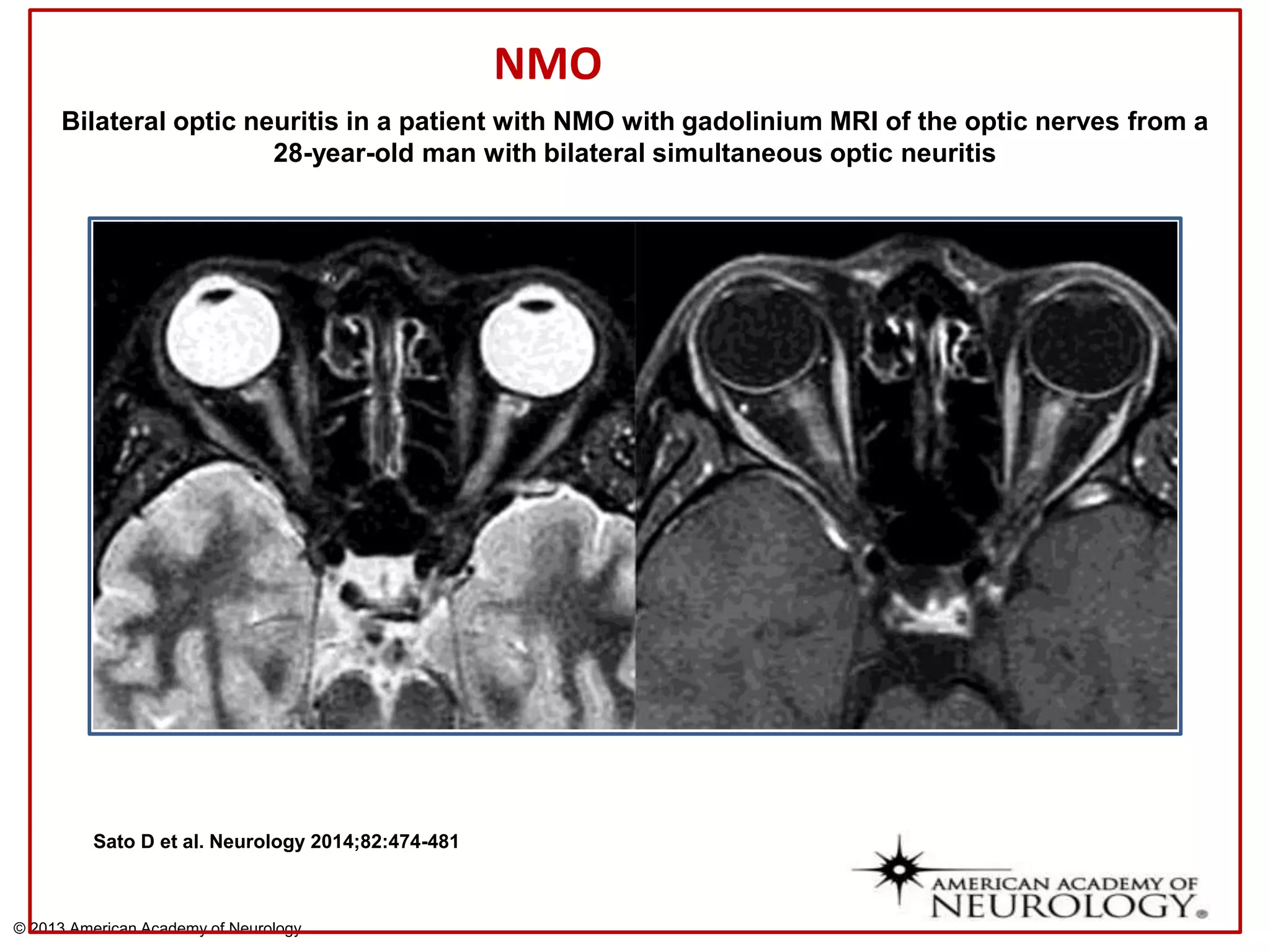 Optic neuritis.Neuroophthalmology, Teaching Slides, Dr M D Mohire ...