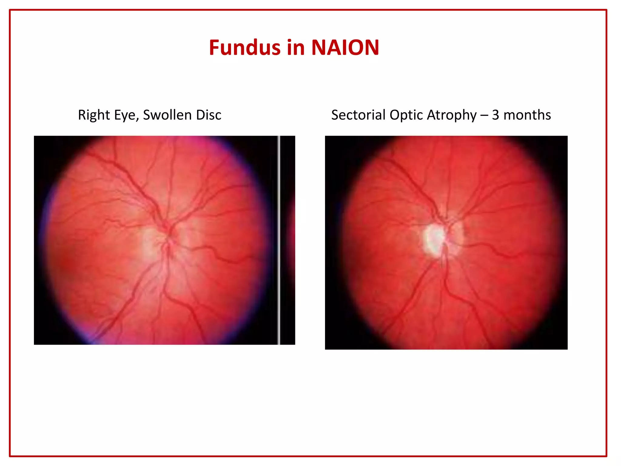 Optic neuritis.Neuroophthalmology, Teaching Slides, Dr M D Mohire ...