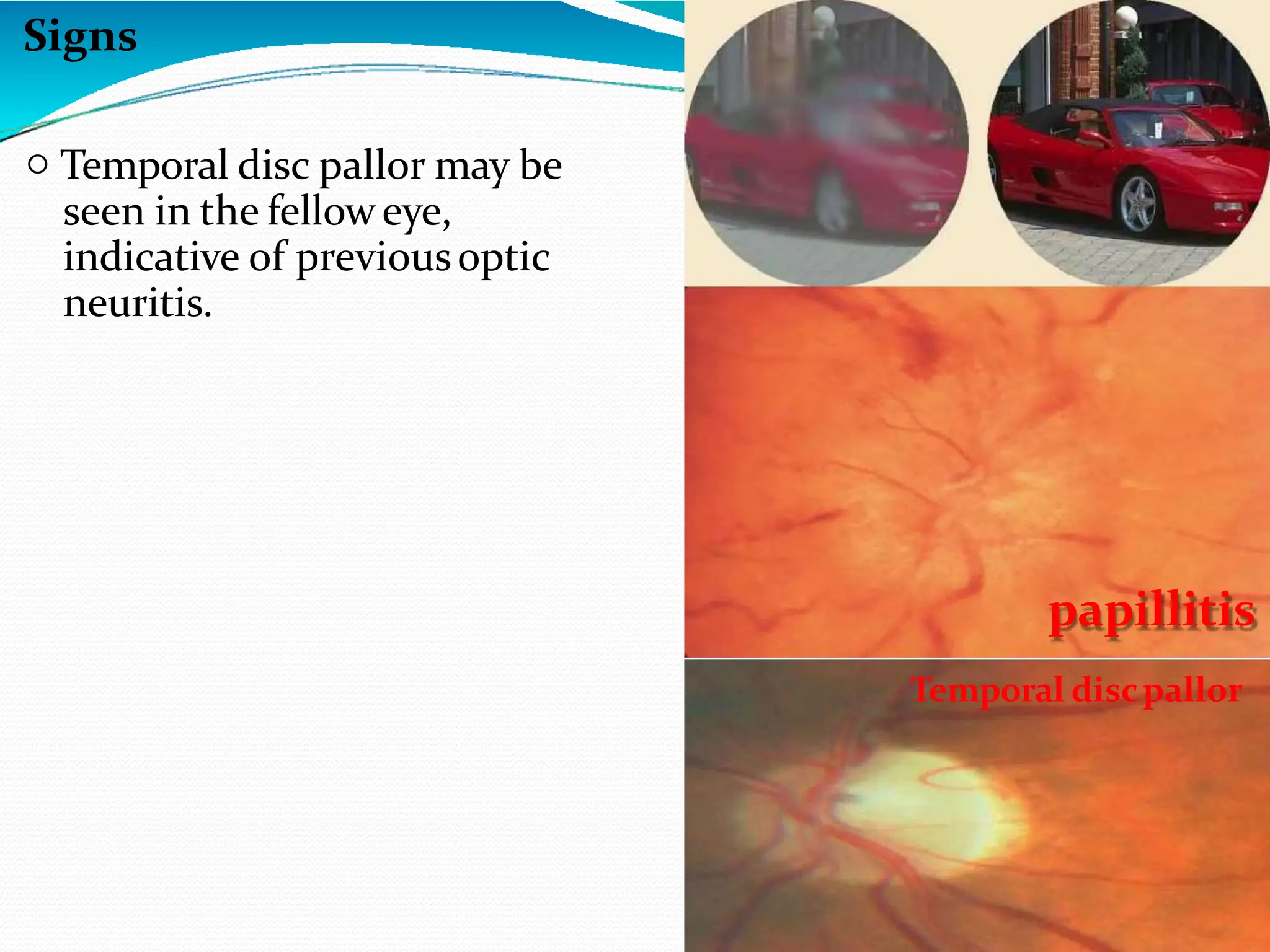 optic neuritis ppt presentation by Dr Usman | PPTX