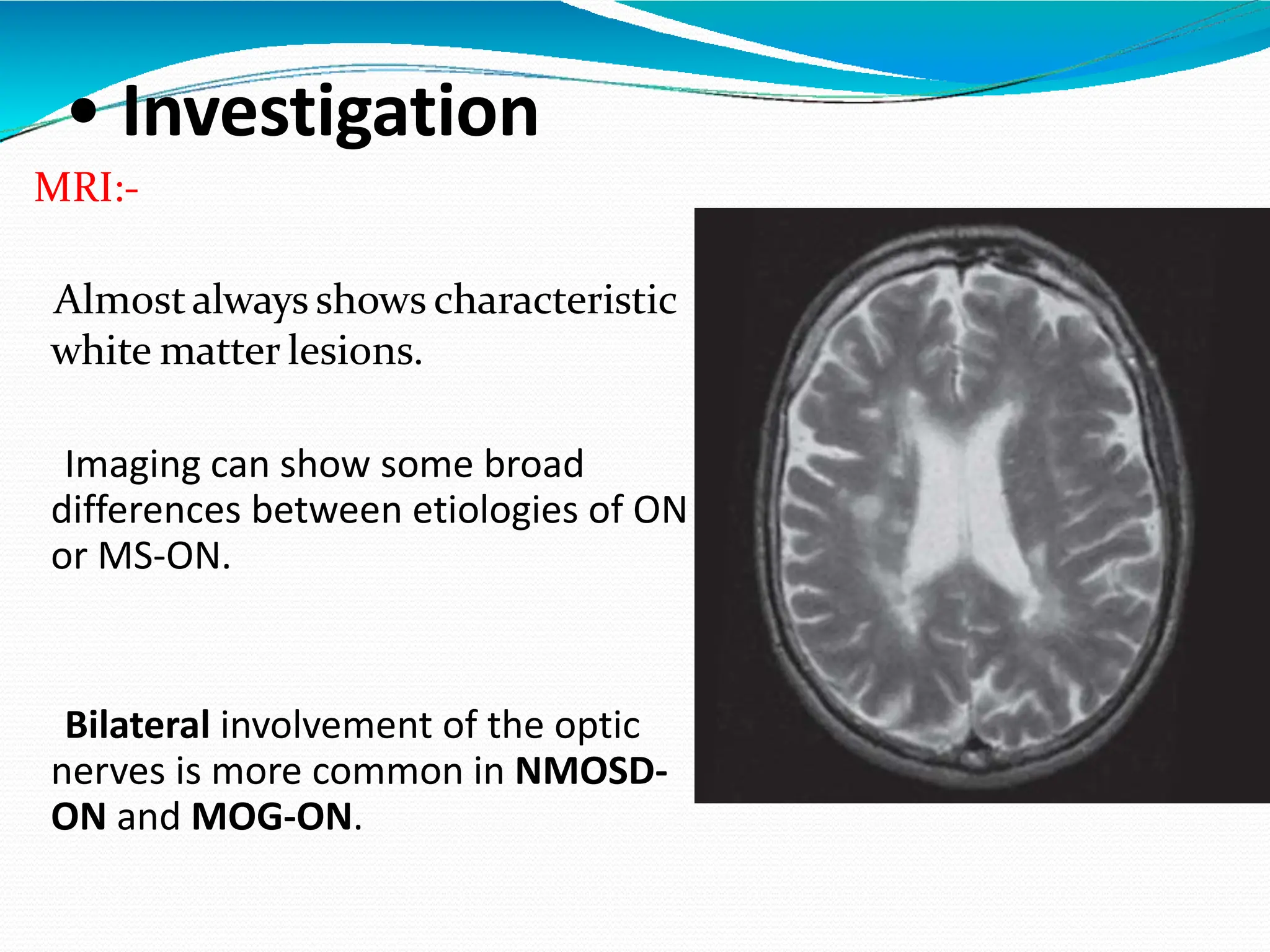 optic neuritis ppt presentation by Dr Usman | PPTX