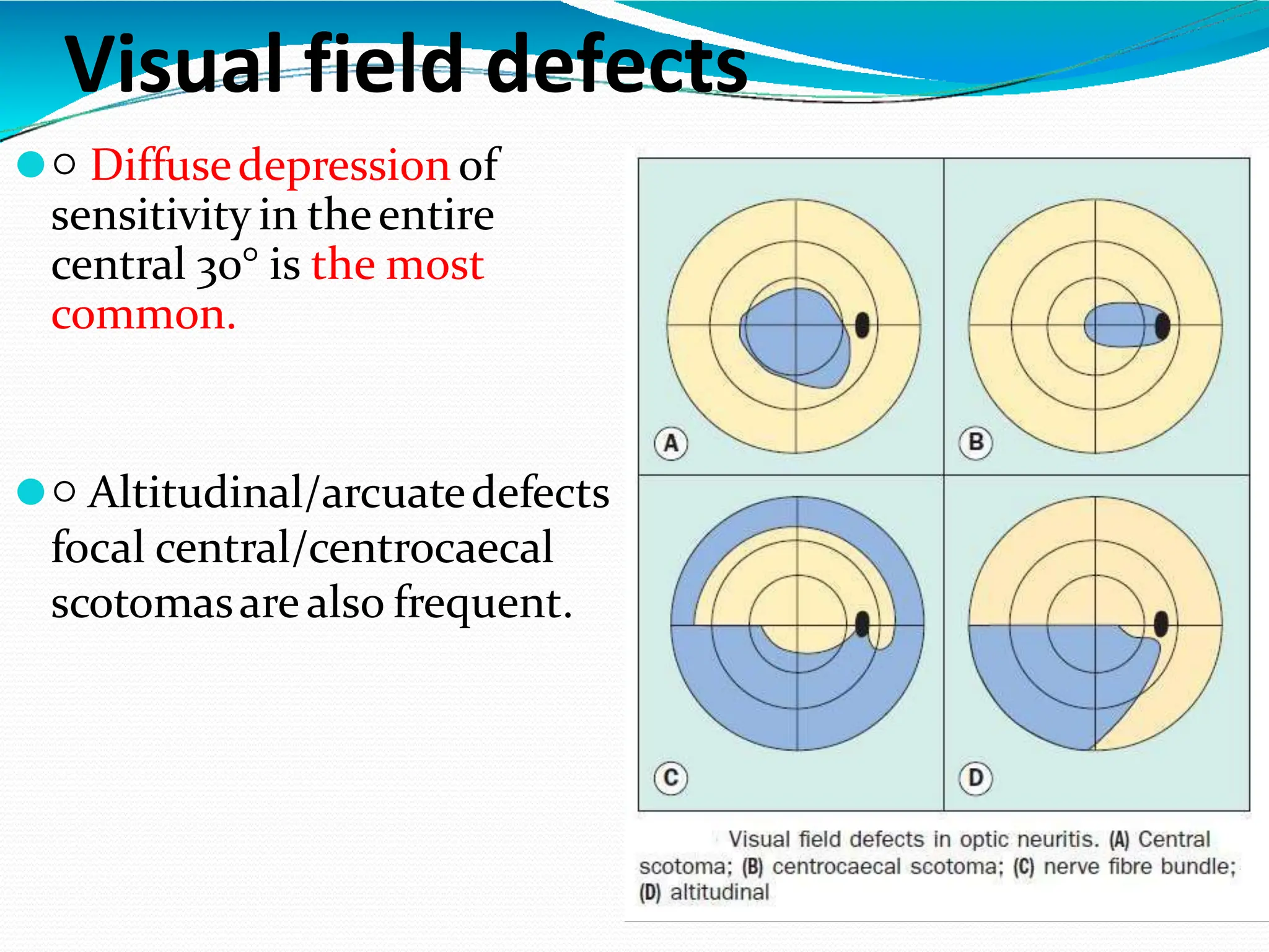 optic neuritis ppt presentation by Dr Usman | PPTX