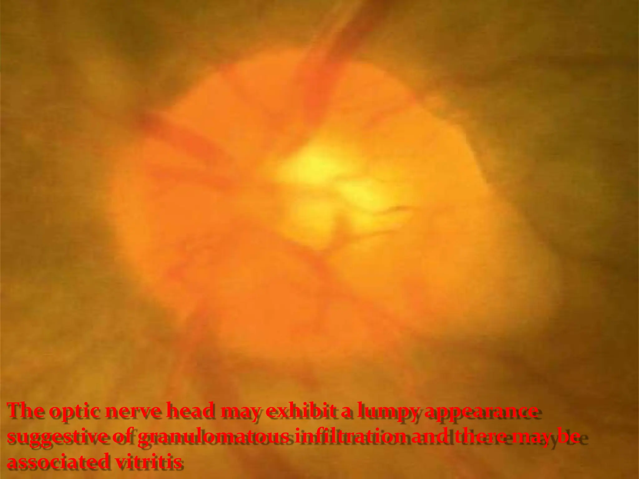 optic neuritis ppt presentation by Dr Usman | PPTX