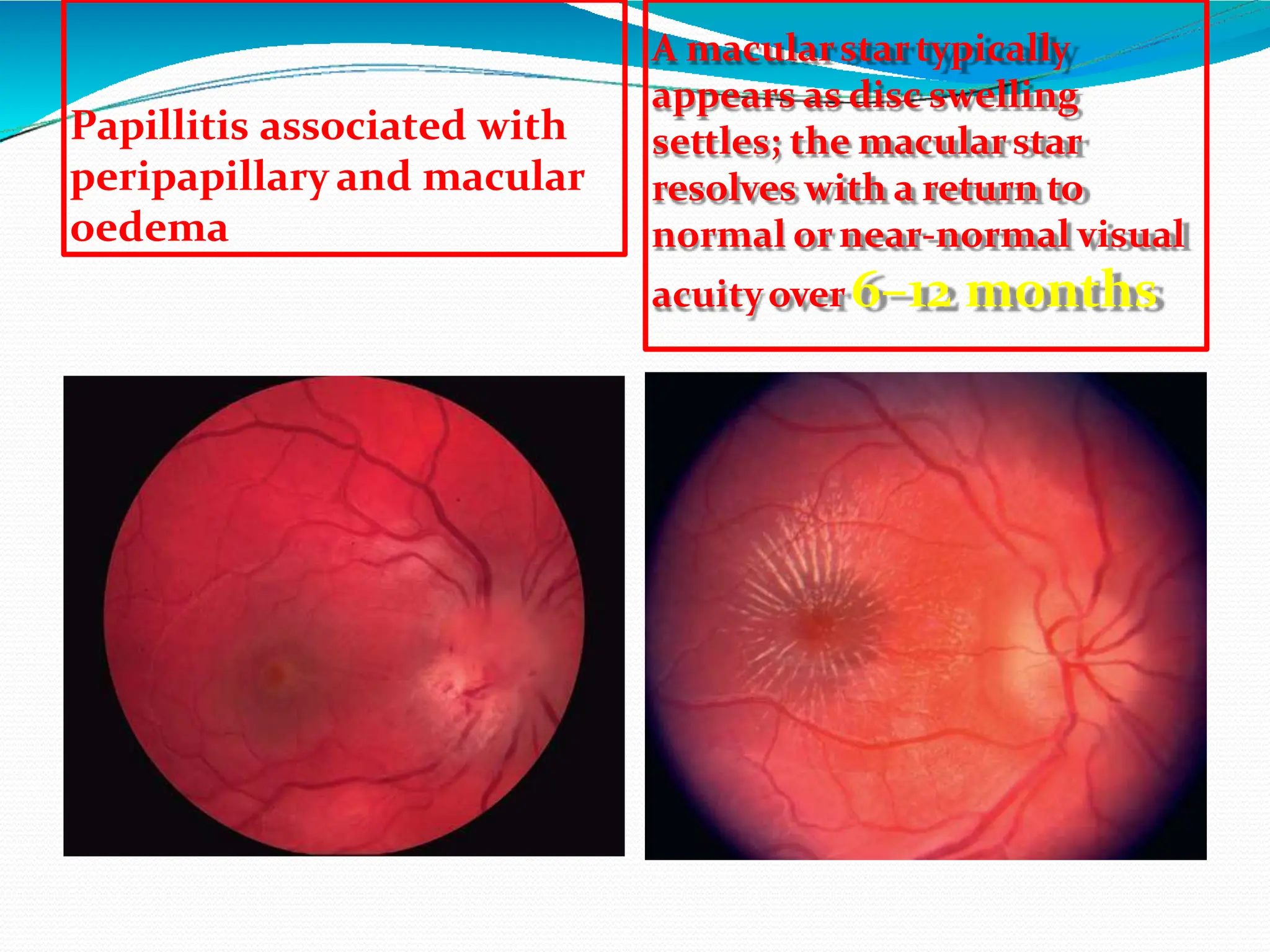 optic neuritis ppt presentation by Dr Usman | PPTX