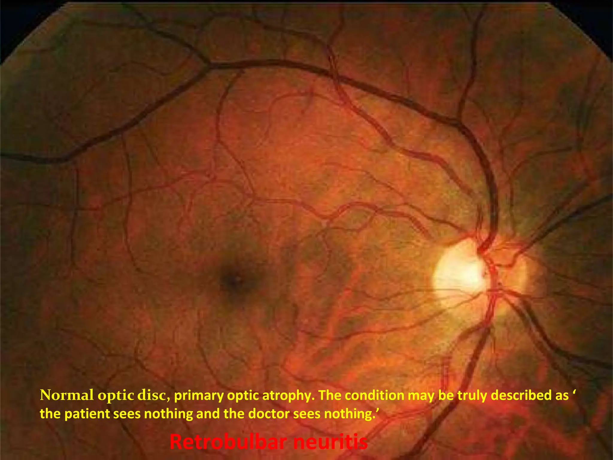 optic neuritis ppt presentation by Dr Usman | PPTX