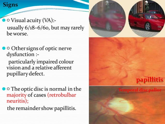 optic neuritis ppt presentation by Dr Usman | PPTX