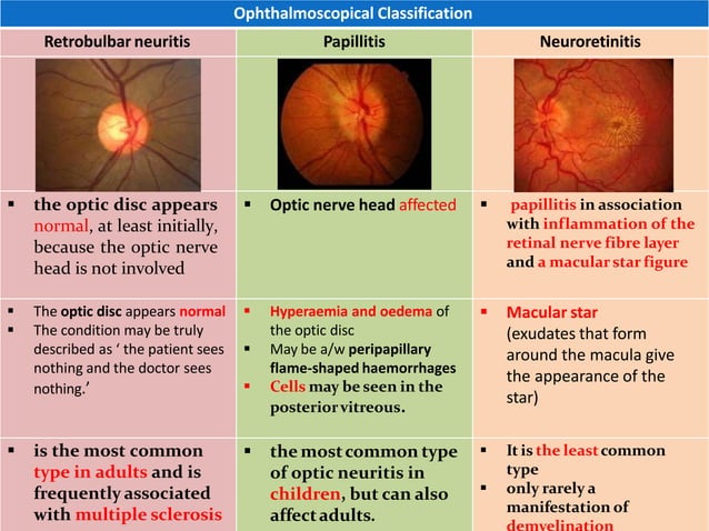 optic neuritis ppt presentation by Dr Usman | PPTX