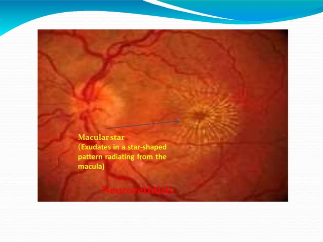 optic neuritis ppt presentation by Dr Usman | PPTX