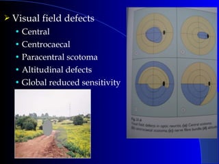 Optic neuritis treatment trial | PPT