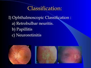 Optic neuritis treatment trial | PPT