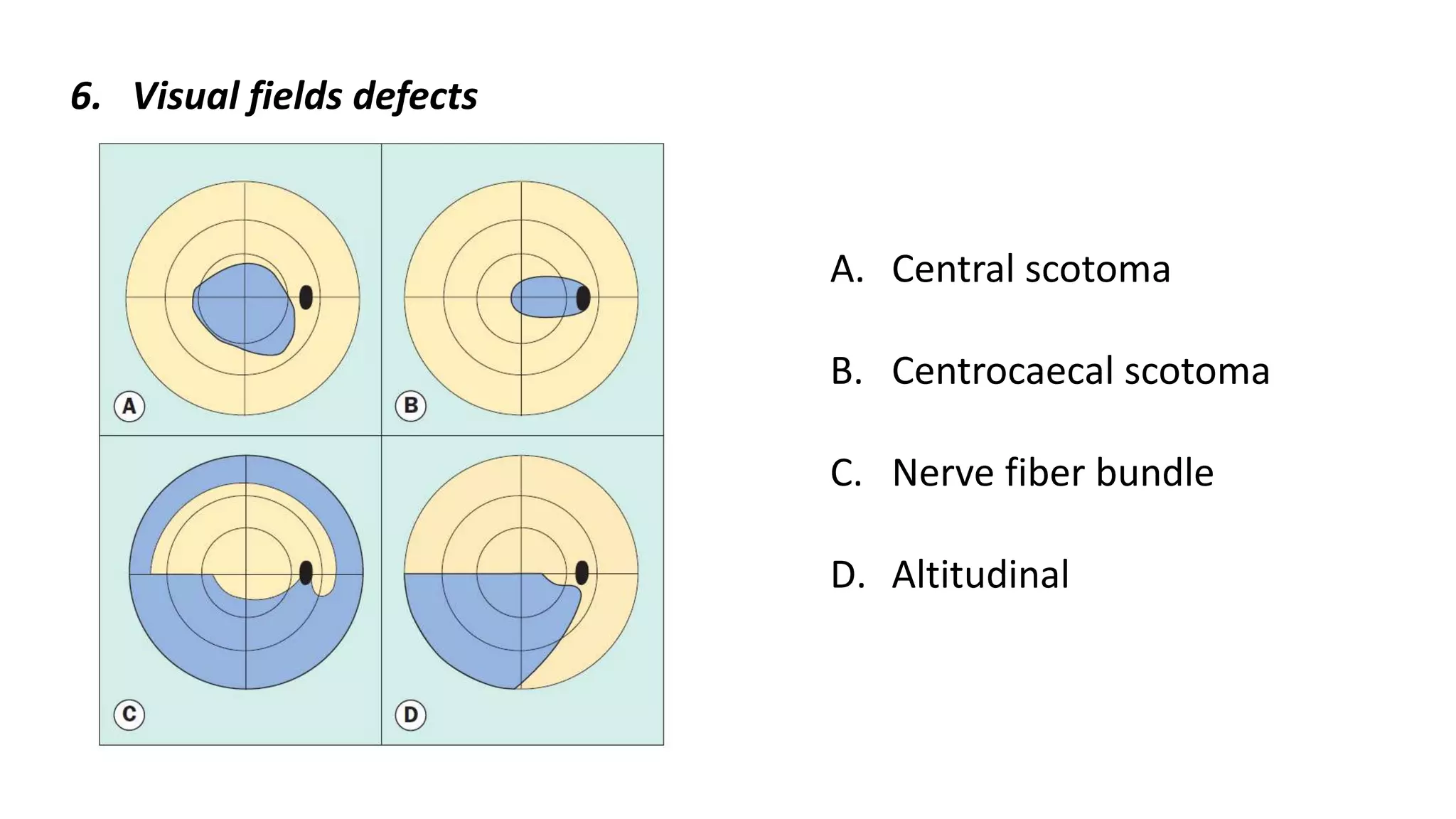 Optic neuritis | PPTX