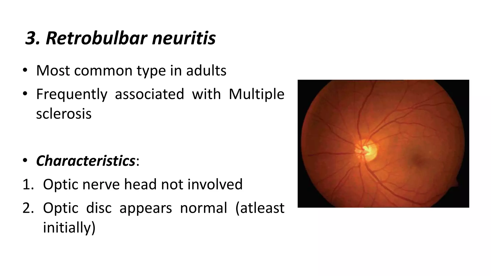 Optic neuritis | PPTX