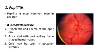 Optic neuritis | PPTX
