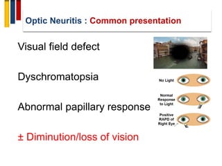 Optic neuropathy | PDF