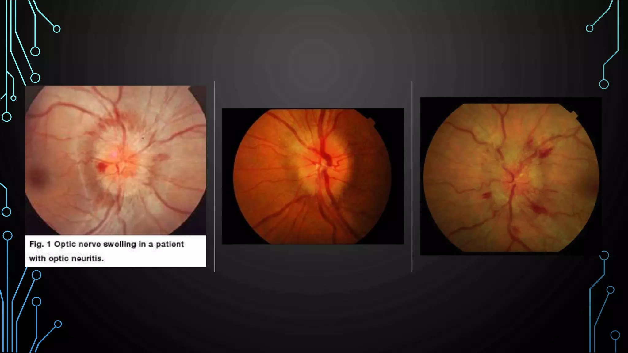 Optic Neuropathy (overview).pptx