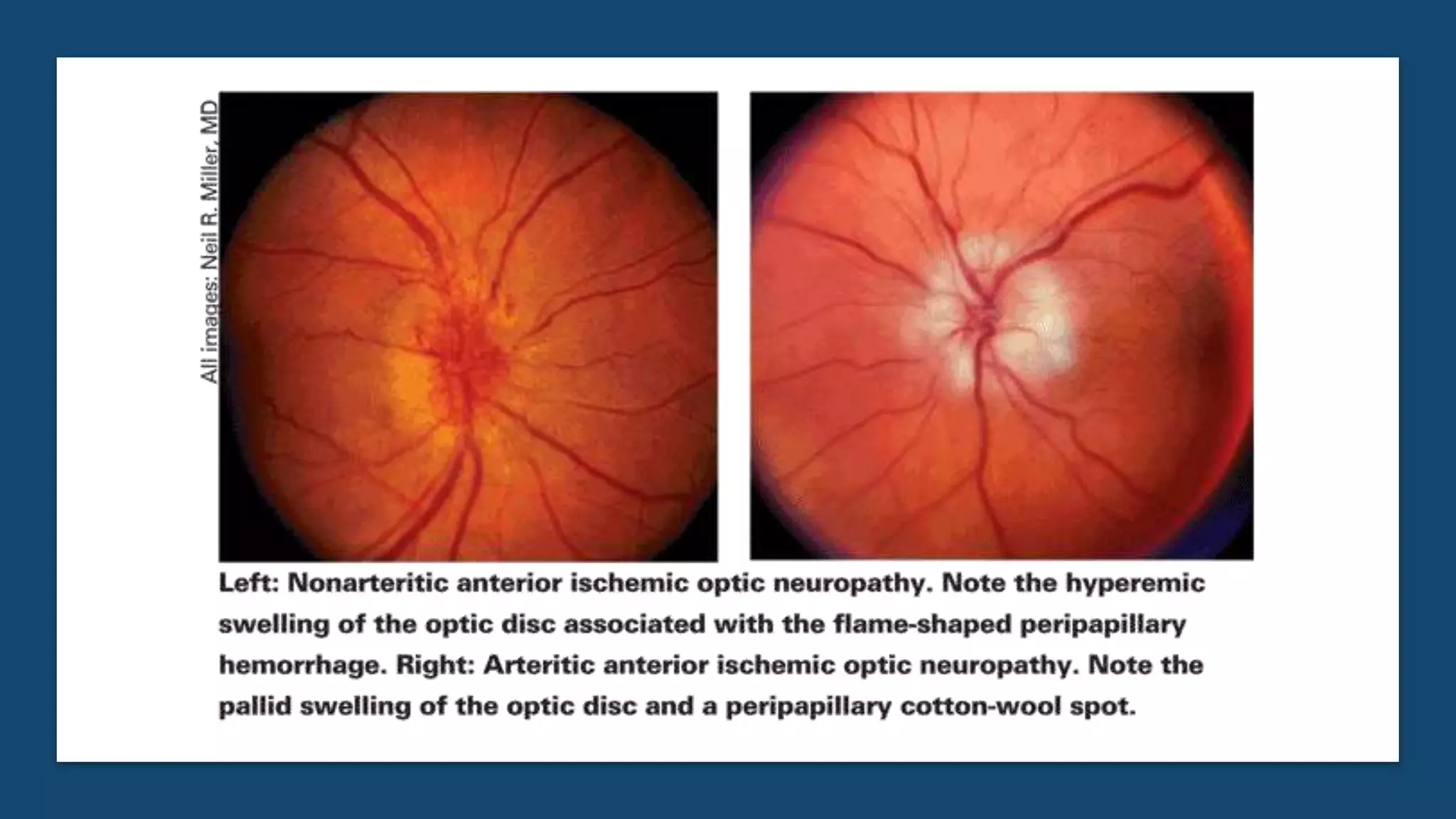 Optic Neuropathy (overview).pptx