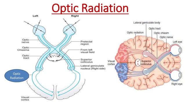 optic pathway and its lesions (2).pptx | Eye and Vision Conditions ...