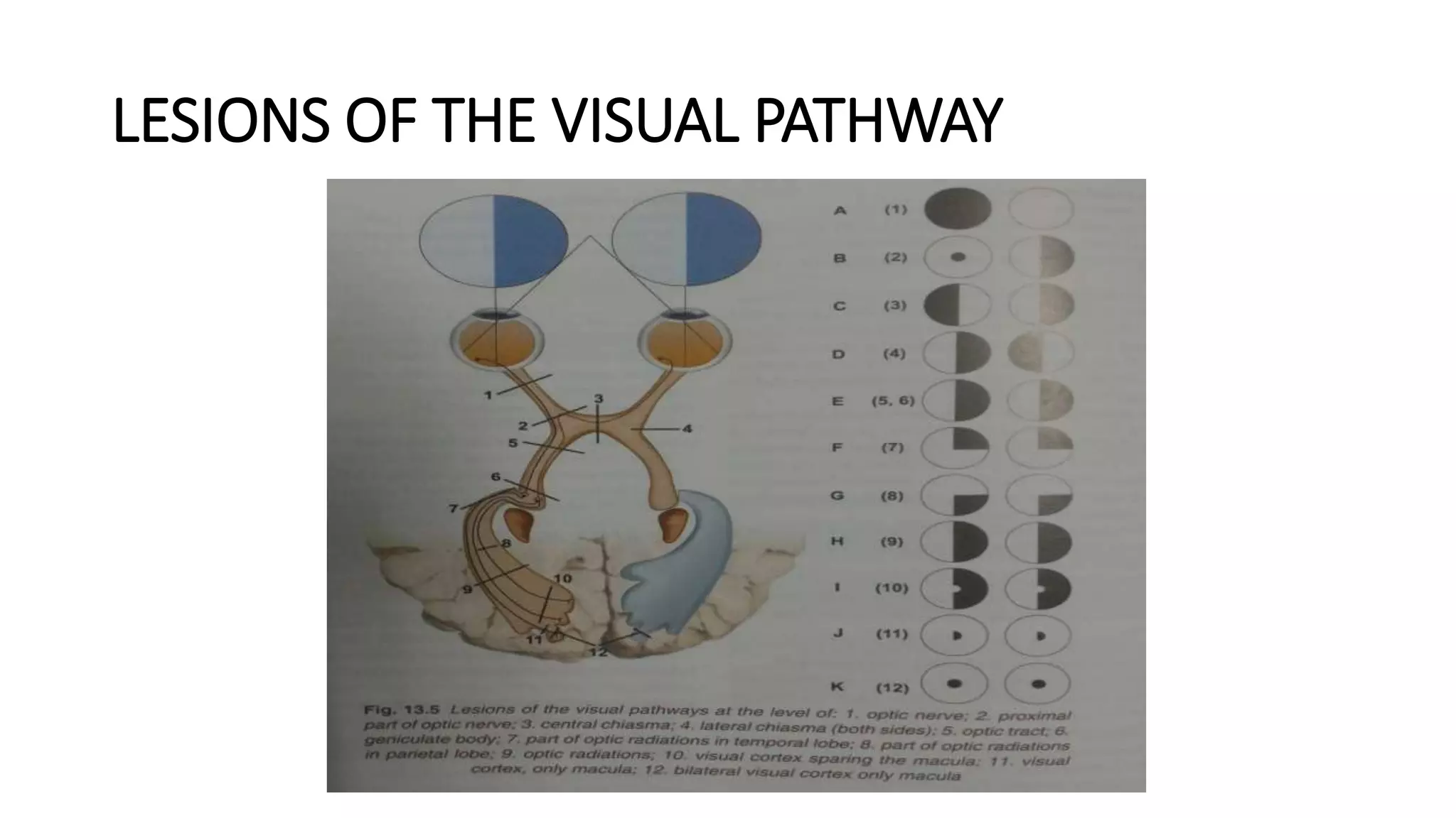 Optic pathway and lesions | PPTX