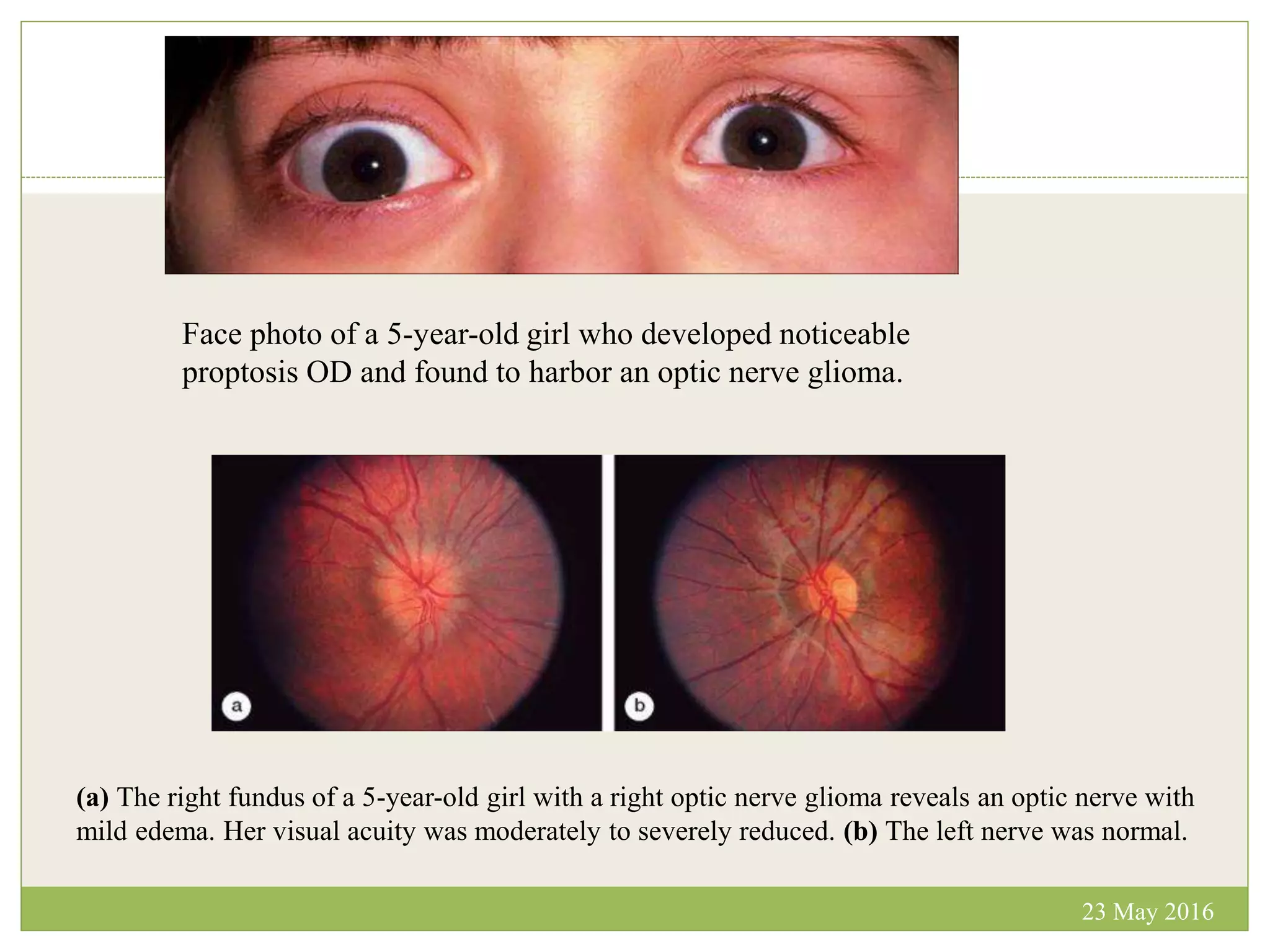 Optic pathway glioma | PPTX