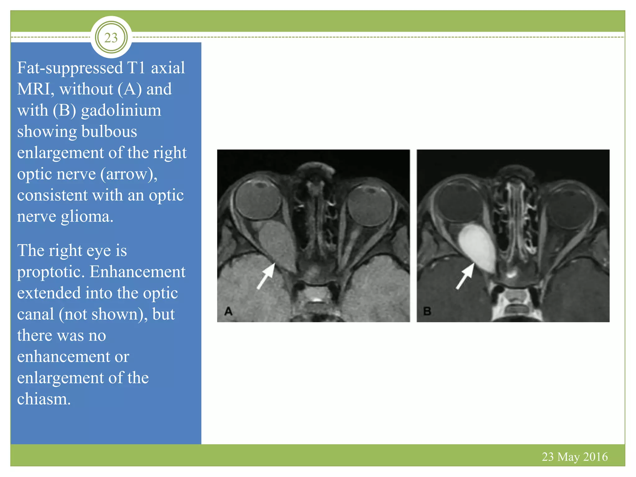 Optic pathway glioma | PPTX