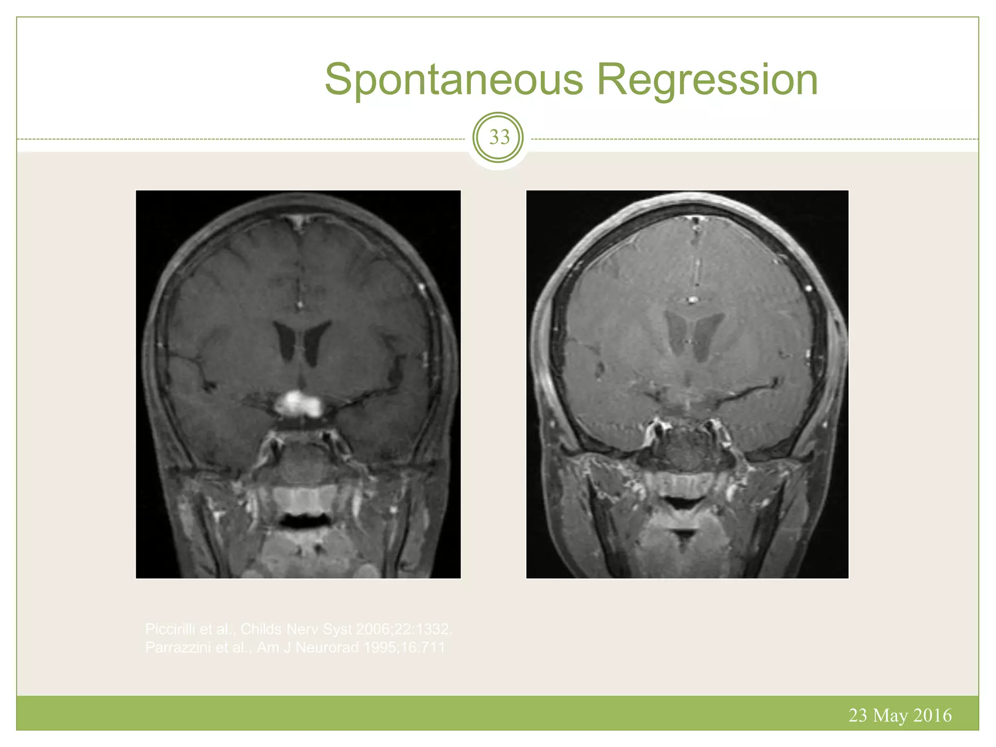 Optic pathway glioma | PPTX