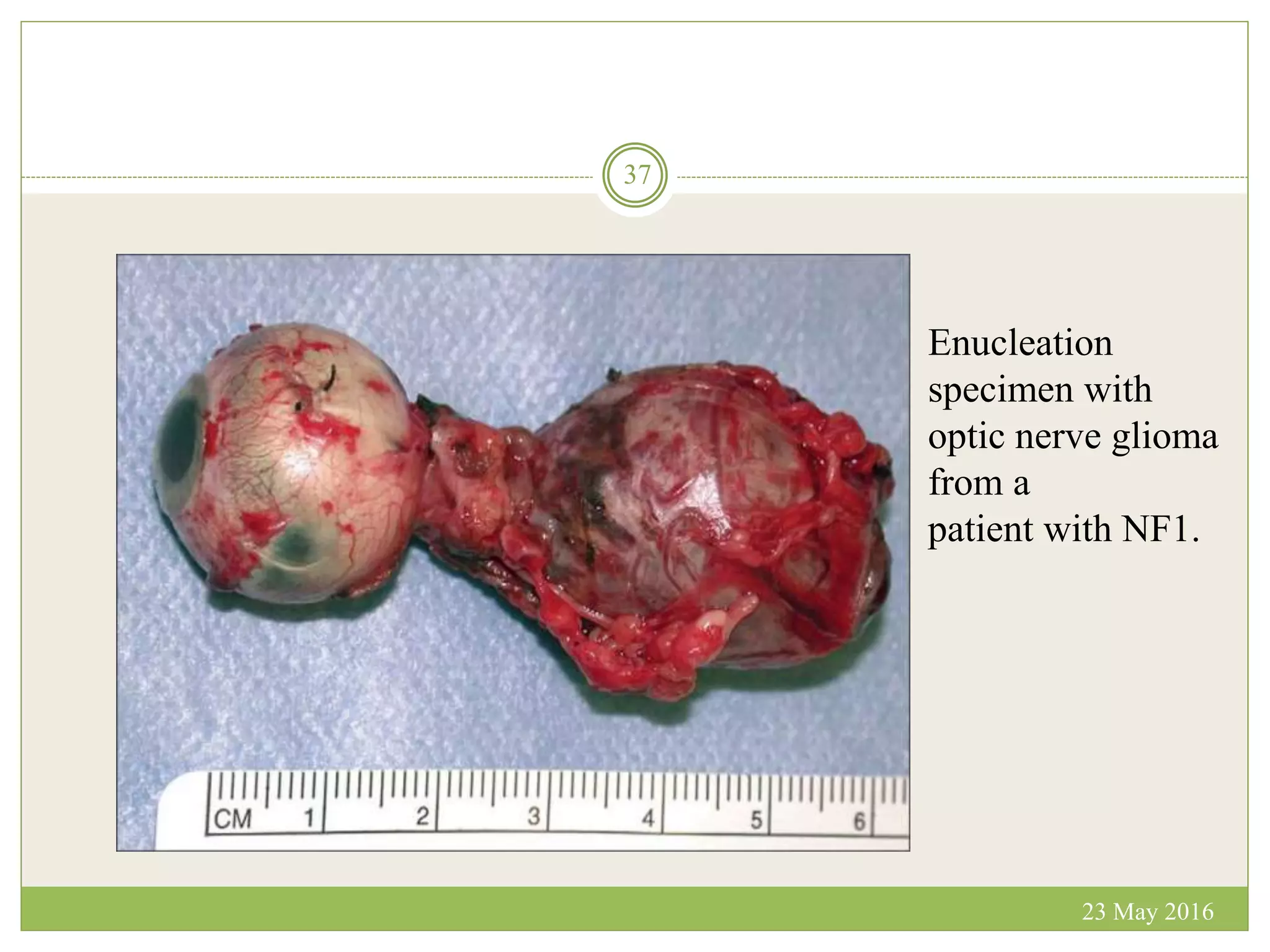 Optic pathway glioma | PPTX