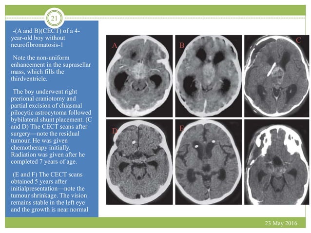 Optic Pathway Glioma Pptx