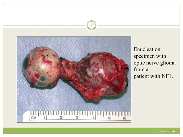 Optic Pathway Glioma Pptx