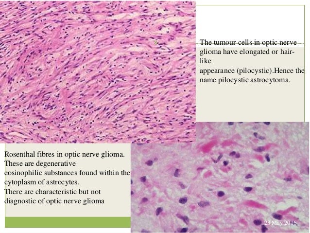 Optic pathway glioma
